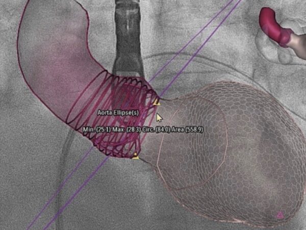 3D model with fluoroscopy (heart imaging) - Herzklinik Hirslanden Zürich